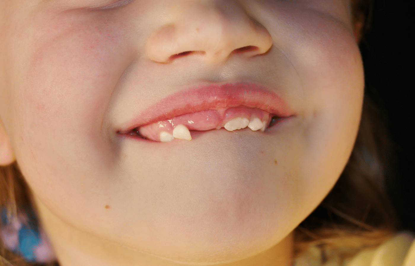 How To Pull A Tooth Without Pain: Tooth Pulling 101 (2026) - Milwaukee ...